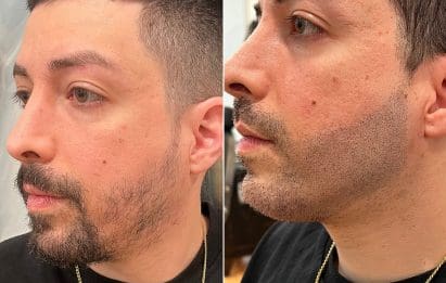 Beard Micropigmentation Treatment | Scalp Micro USA