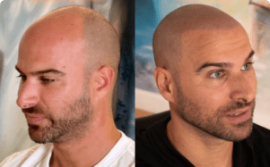 Scalp Micropigmentation Locations | Scalp Micro USA