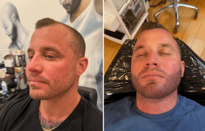 Beard Micropigmentation Treatment | Scalp Micro USA