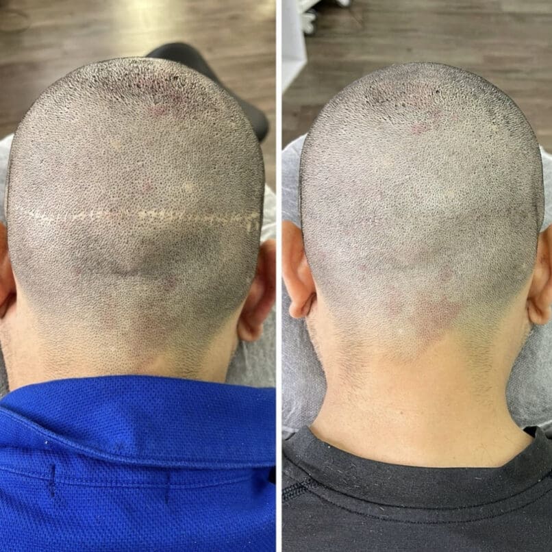 Hair Transplant Scar Camouflage | FUE & FUT | Scalp Micro USA
