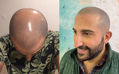 Scalp Micropigmentation Locations | Scalp Micro USA