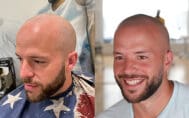 Scalp Micropigmentation in New York City, NY | Scalp Micro USA