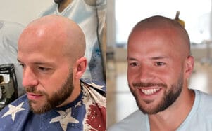 Scalp Micropigmentation in New York City, NY | Scalp Micro USA