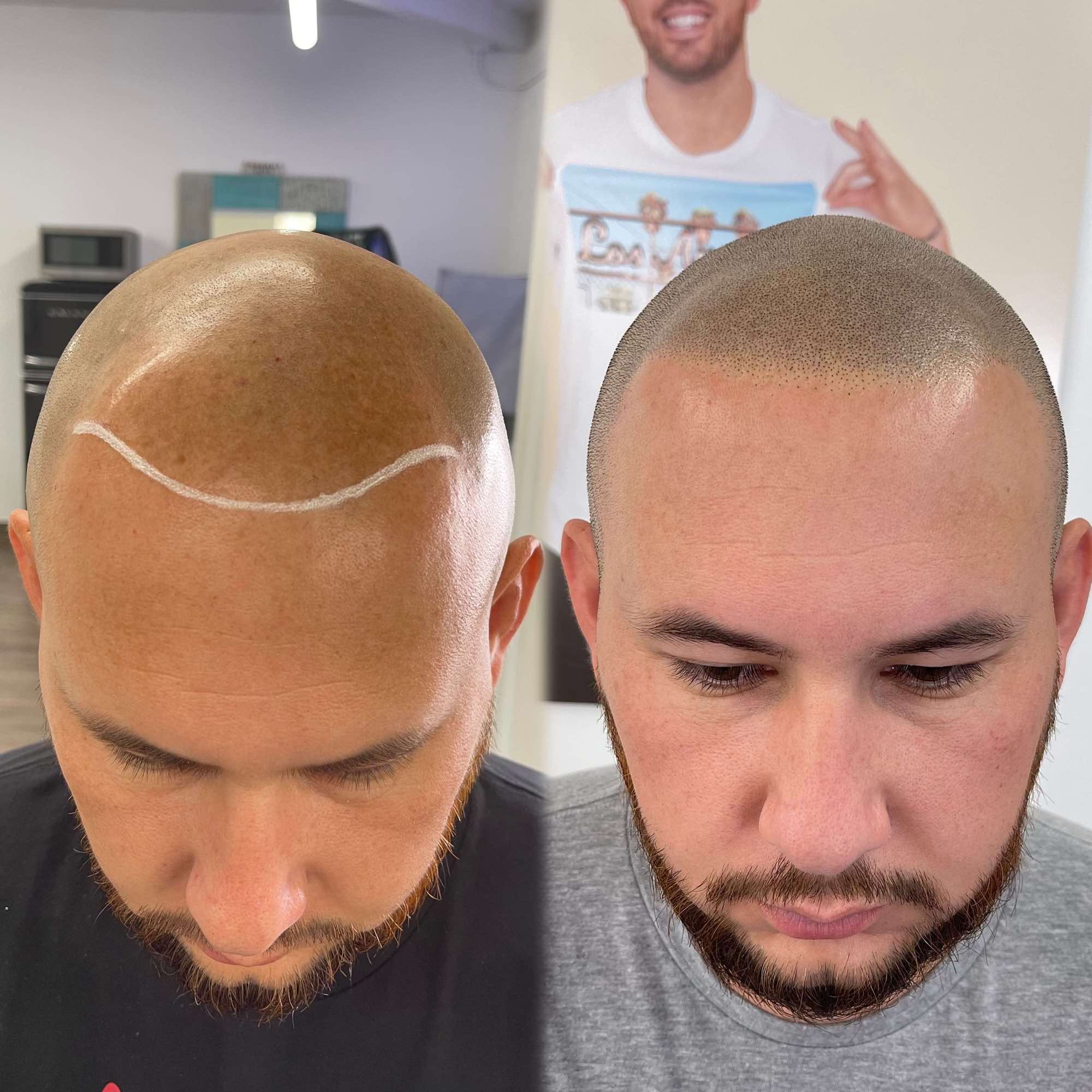 Brad Bohannon Scalp Micropigmentation Los Angeles | Scalp Micro USA