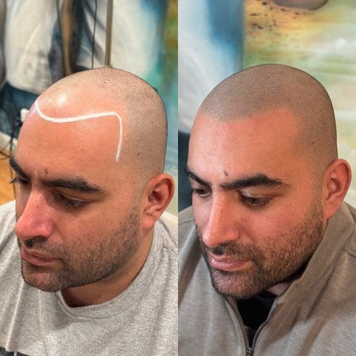 Max Fierro Scalp Micropigmentation in NYC | Scalp Micro USA