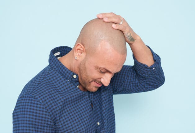 What is DHT and how does it impact hair loss? - Scalp Micro USA