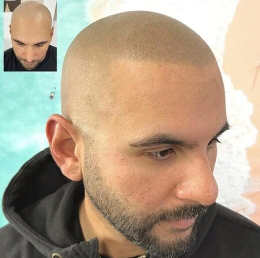Derek Bogner Scalp Micropigmentation Los Angeles | Scalp Micro USA