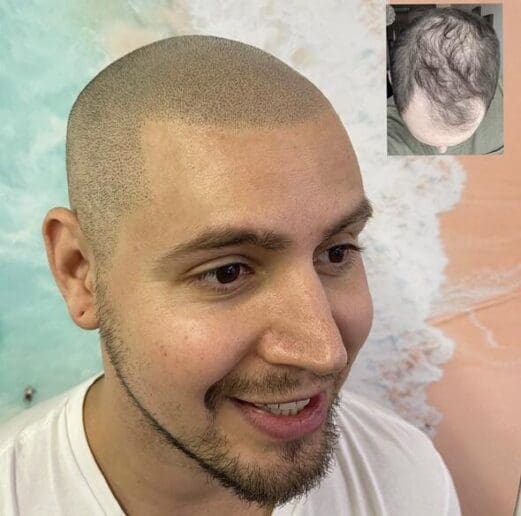 Derek Bogner Scalp Micropigmentation Los Angeles | Scalp Micro USA