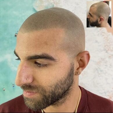 Derek Bogner Scalp Micropigmentation Los Angeles | Scalp Micro USA