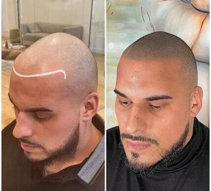 Max Fierro Scalp Micropigmentation in NYC | Scalp Micro USA