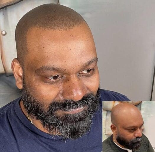 Max Fierro Scalp Micropigmentation in NYC | Scalp Micro USA