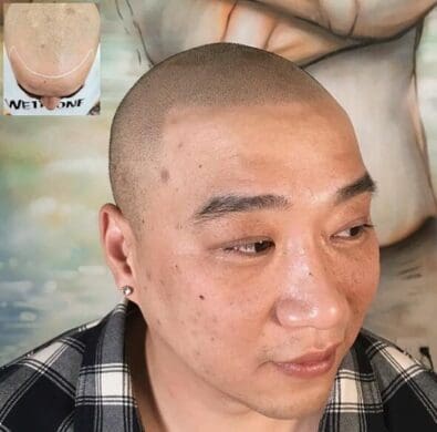 Matt Iulo Scalp Micropigmentation in NYC | Scalp Micro USA