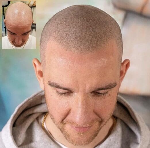 Matt Iulo Scalp Micropigmentation in NYC | Scalp Micro USA