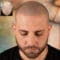 Matt Iulo Scalp Micropigmentation in NYC | Scalp Micro USA