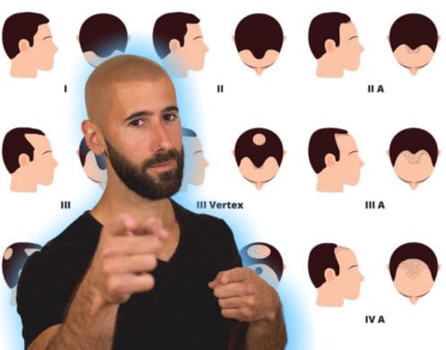 The Norwood Scale: Hair Loss Stages - Scalp Micro USA