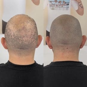 Alopecia Scalp Micropigmentation Treatment | Scalp Micro USA