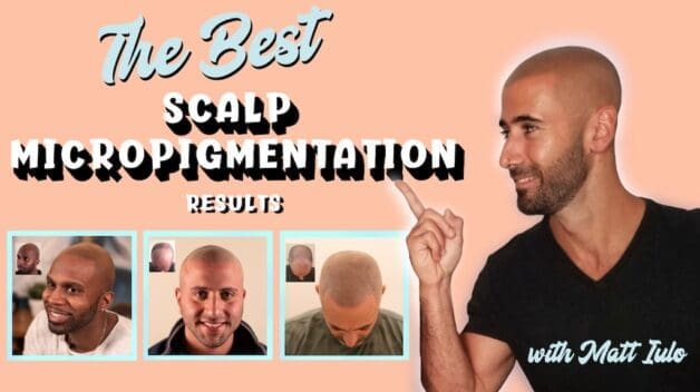 The Best Scalp Micropigmentation Results 2 - Scalp Micro USA