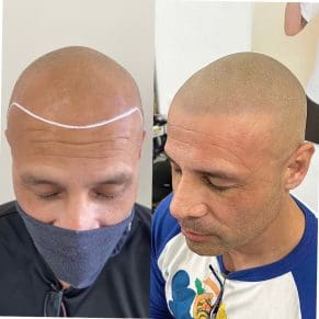 Derek Bogner Scalp Micropigmentation Los Angeles | Scalp Micro USA
