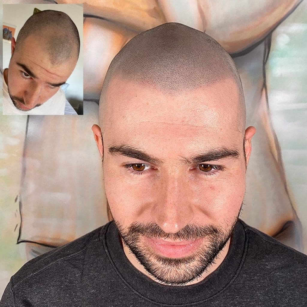 Mike Sosna Scalp Micropigmentation in Fort Lauderdale, Florida