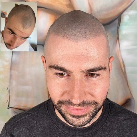 Mike Sosna Scalp Micropigmentation in Fort Lauderdale, Florida