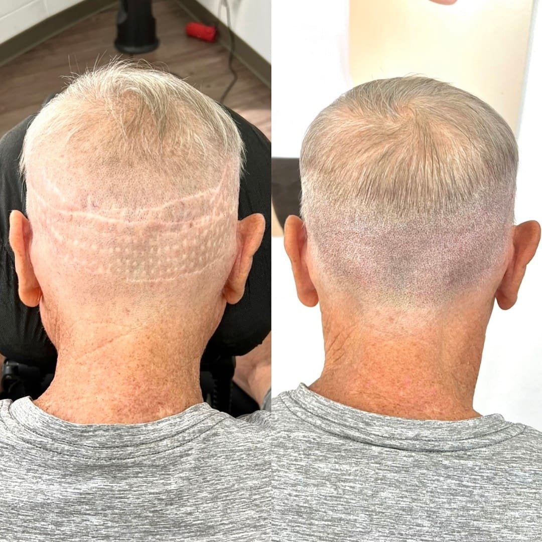 Hair Transplant Scar Camouflage | FUE & FUT | Scalp Micro USA