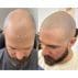 Derek Bogner Scalp Micropigmentation Los Angeles | Scalp Micro USA