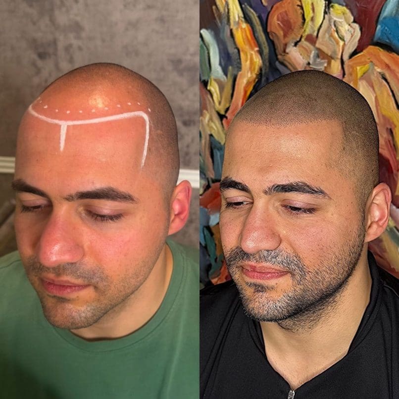 Mike Sosna Scalp Micropigmentation in Fort Lauderdale, Florida