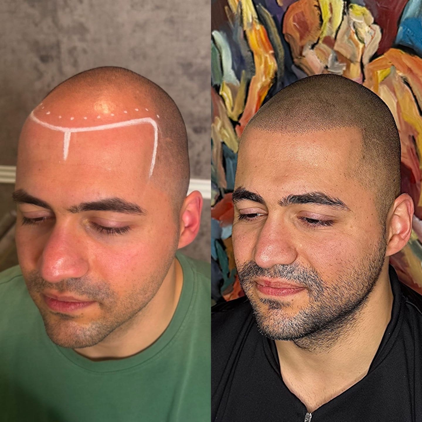 Mike Sosna Scalp Micropigmentation in Fort Lauderdale, Florida