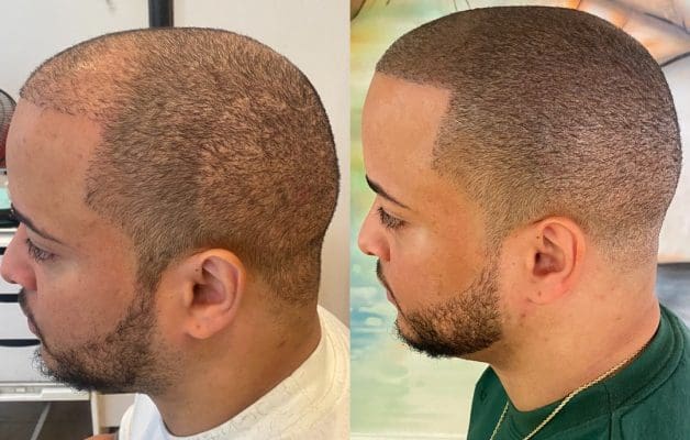 Treatments - Scalp Micro USA