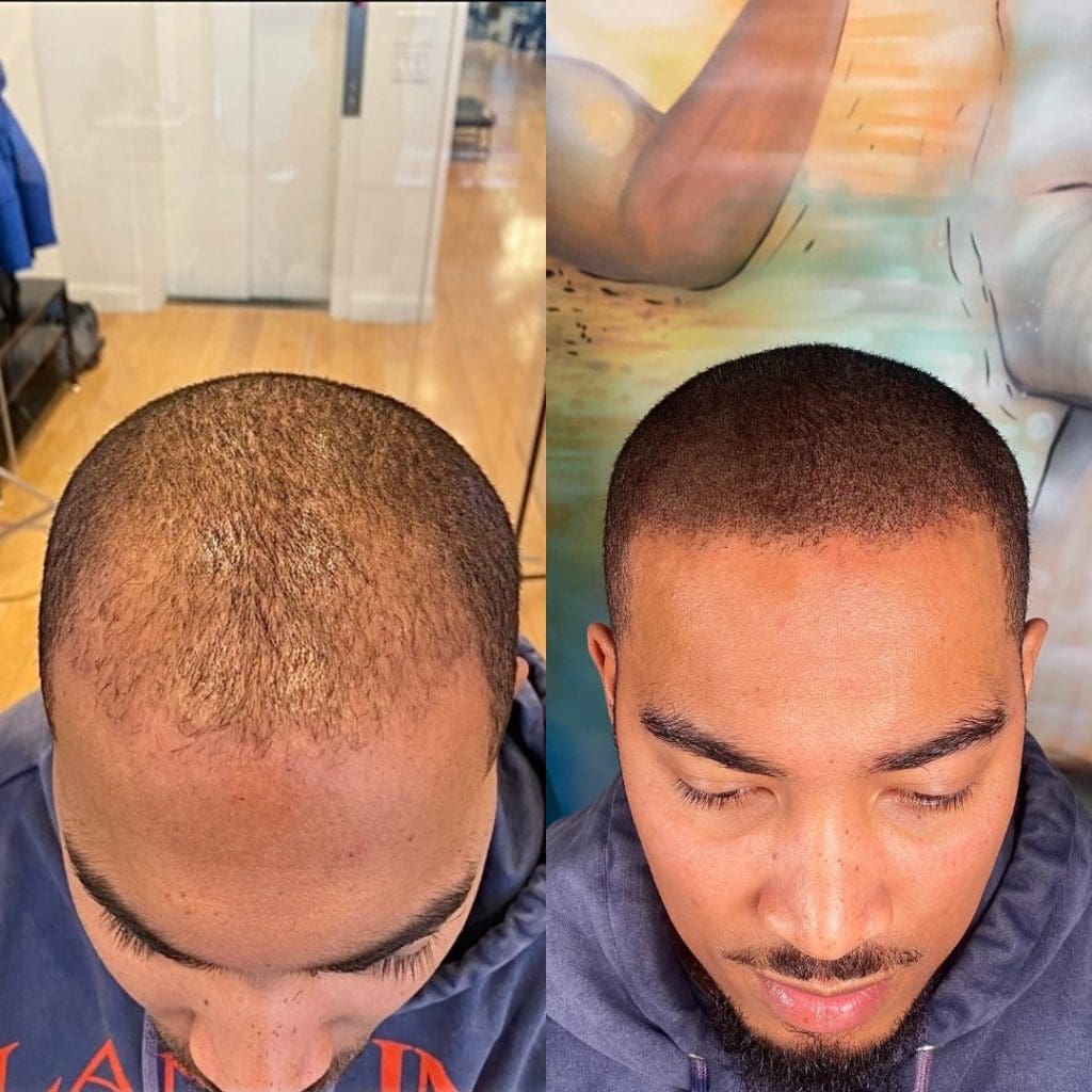 Hair Loss Density Fill | Scalp Micro USA