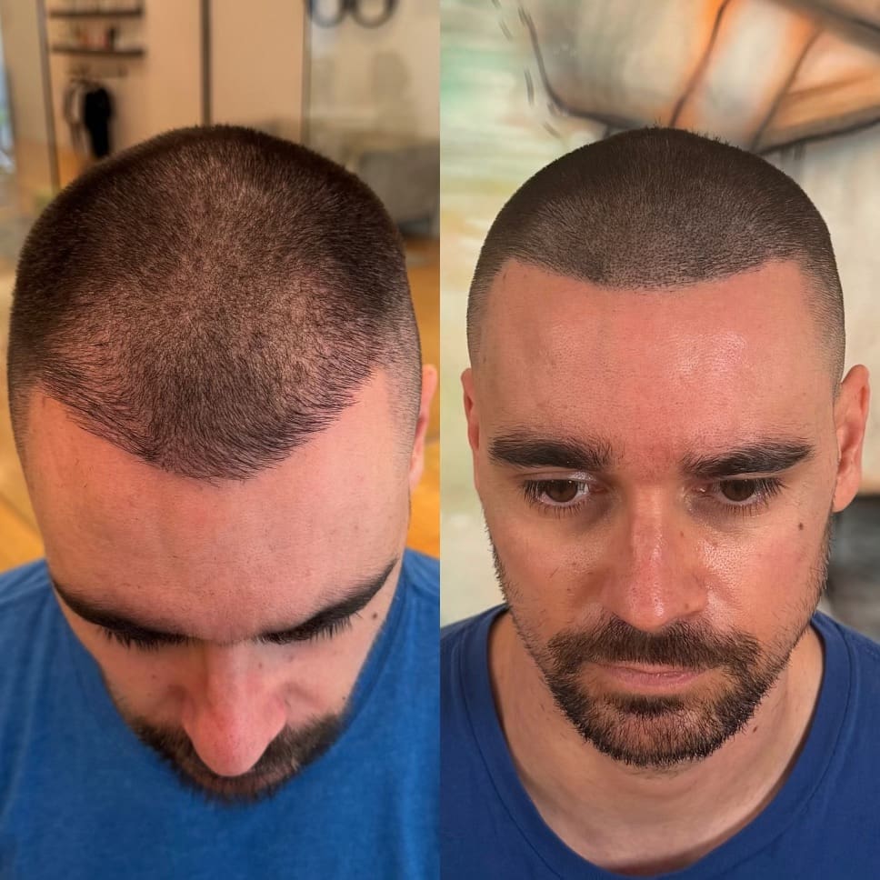 Hair Loss Density Fill | Scalp Micro USA