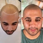 Best Scalp Micropigmentation | Scalp Micro USA