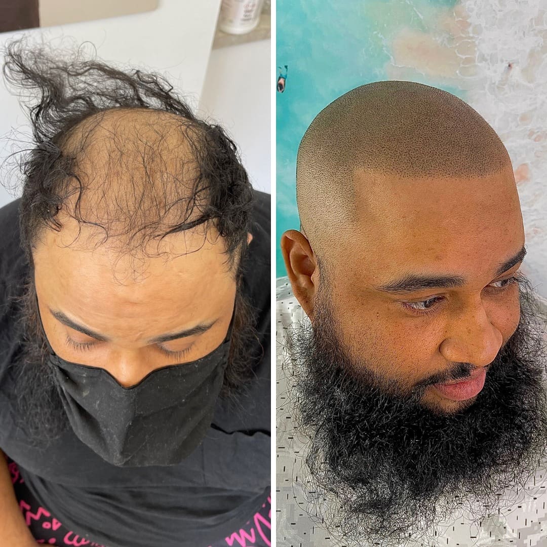 Best Scalp Micropigmentation | Scalp Micro USA