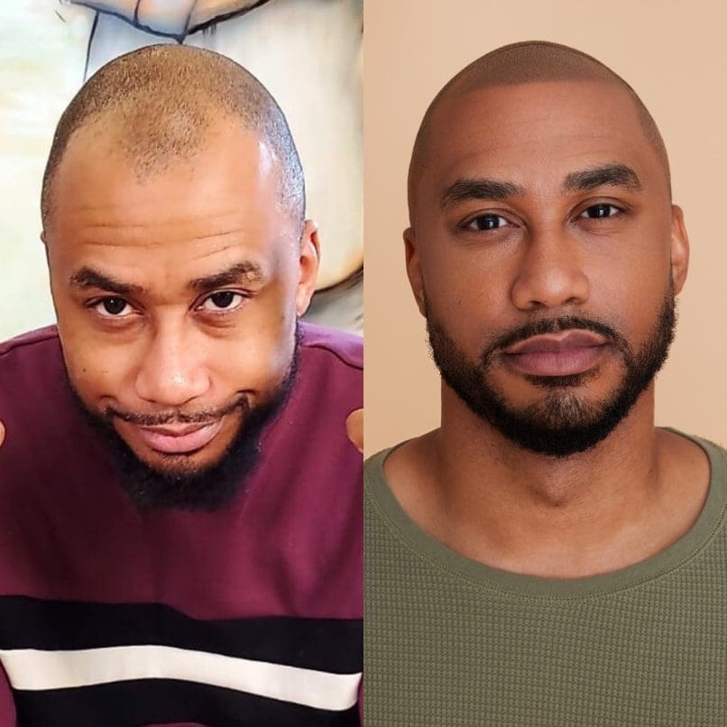 Best Scalp Micropigmentation | Scalp Micro USA