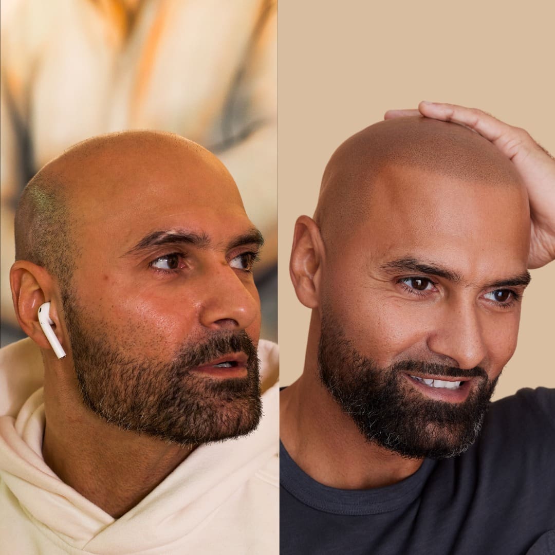 Hairloss Treatments | Scalp Micro USA